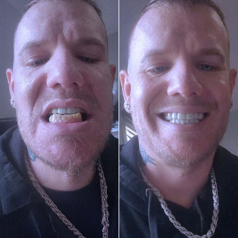 Pop On & Smile With Confidence – Pop On Veneers