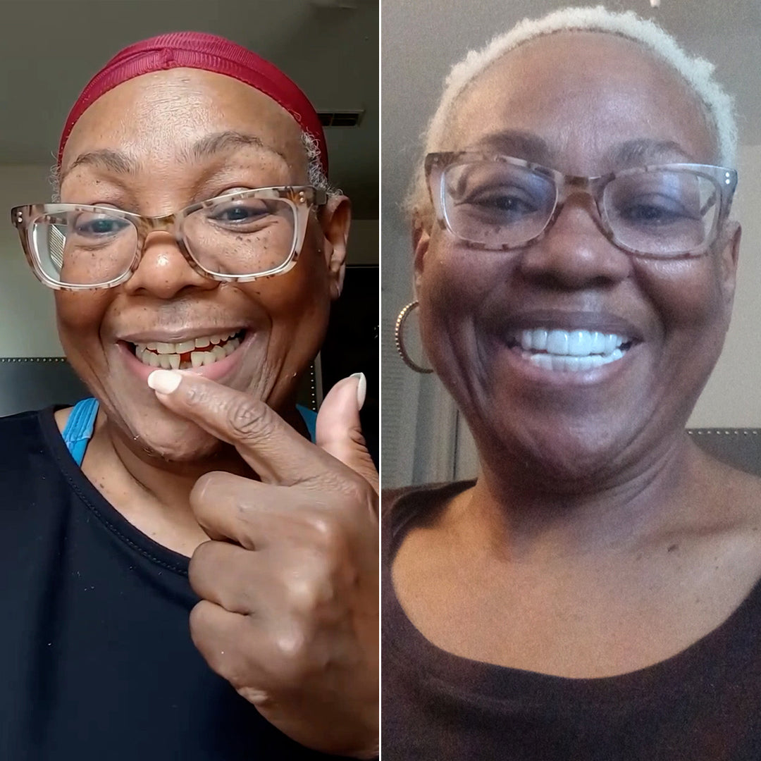 Got a beautiful new smile! – Pop On Veneers