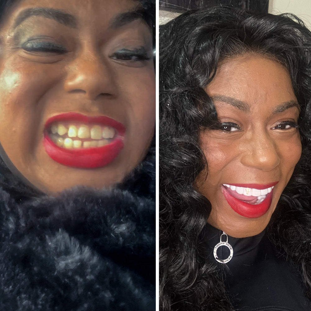 Smile Stories – Pop On Veneers