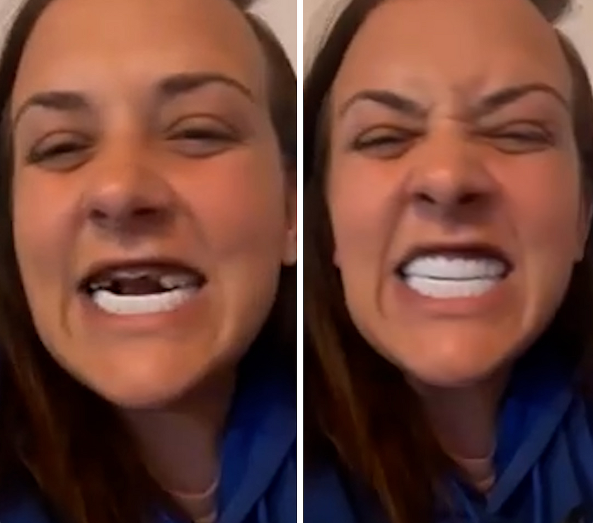 Get yourself a set of Pop Ons! – Pop On Veneers