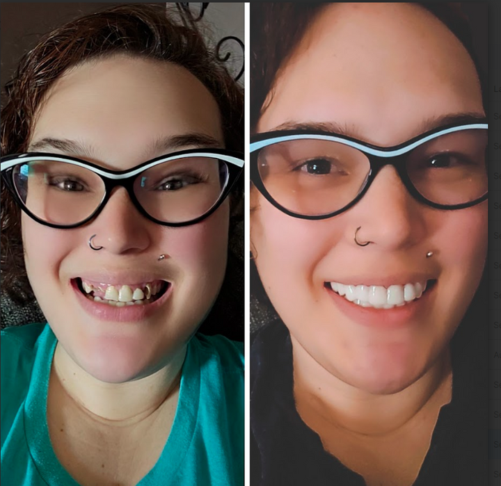 Smile Stories – Pop On Veneers