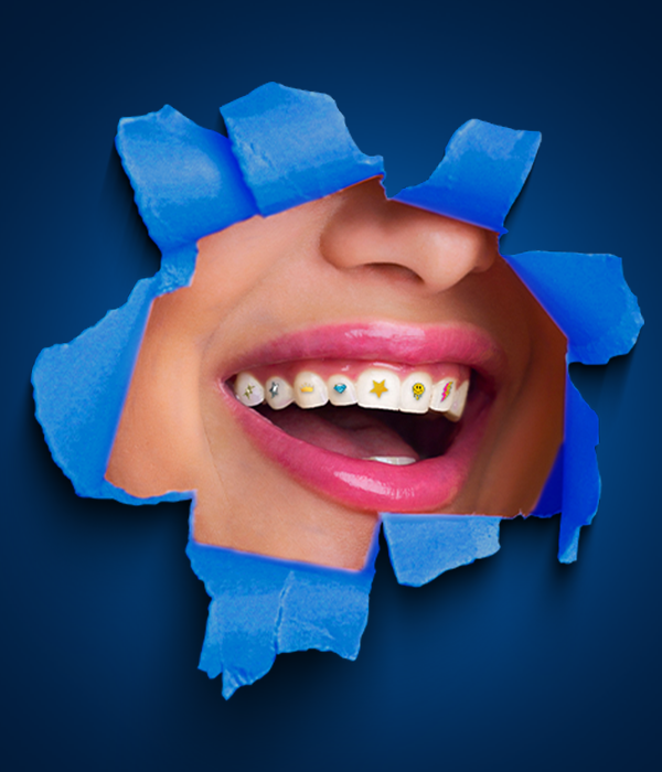 Pop on Bling – Pop On Veneers
