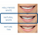 Pop On Your Smile - POP ON VENEERS – Pop on Veneers