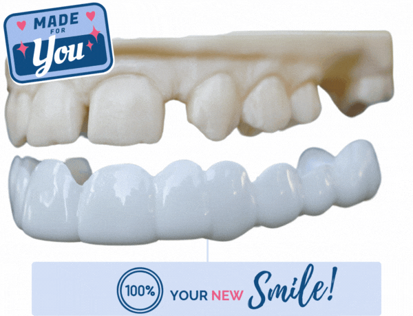 AT-HOME IMPRESSION KIT – Pop On Veneers